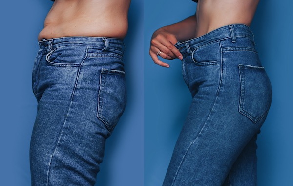 Liposuction - Glopedia